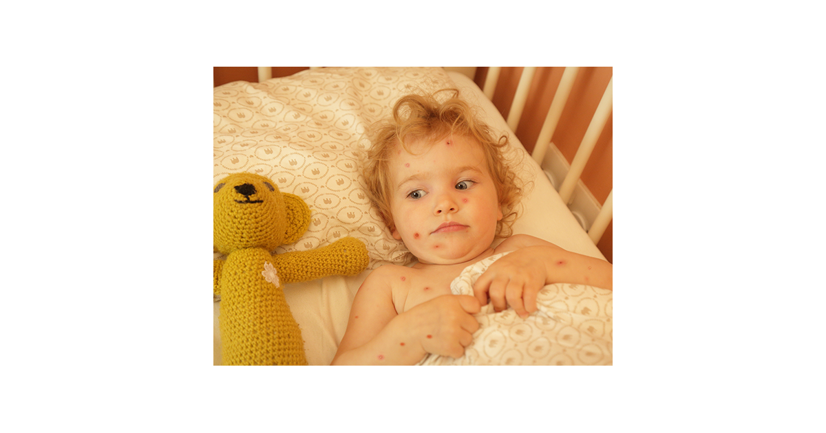 La varicela en los bebés: Síntomas y cómo tratar | Nestlé Bebé