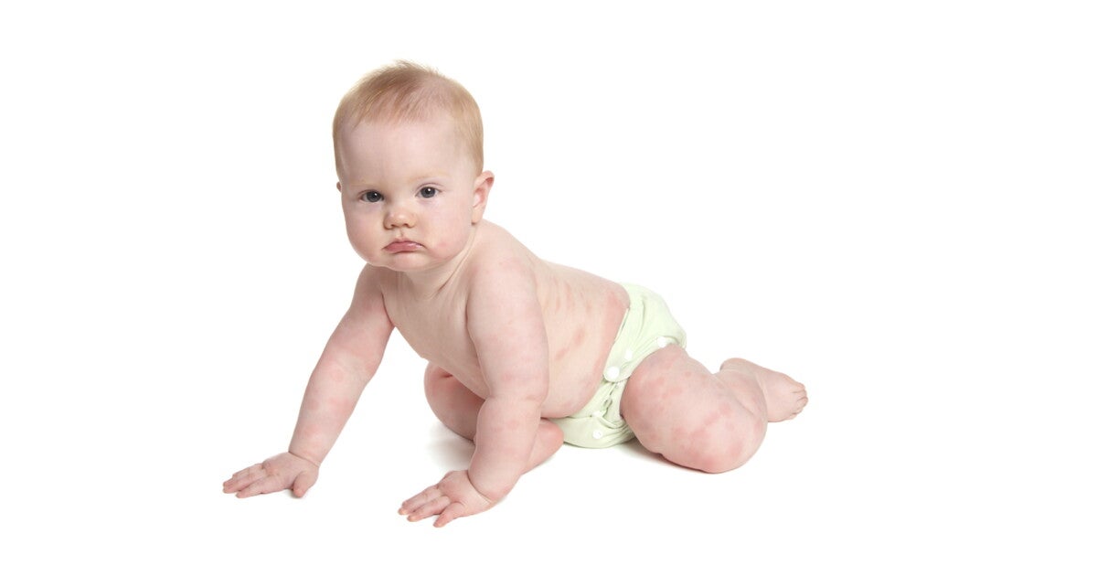 Prevenir alergias en bebés | Nestlé Bebé